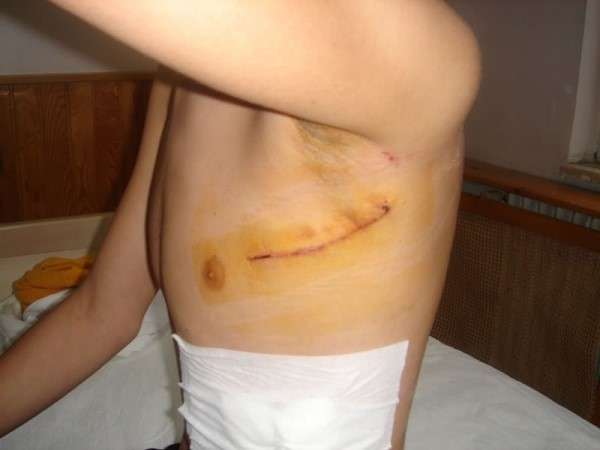 Open Lung Surgery (Thoracotomy) - Thoracic Surgery - Lung Cancer ...